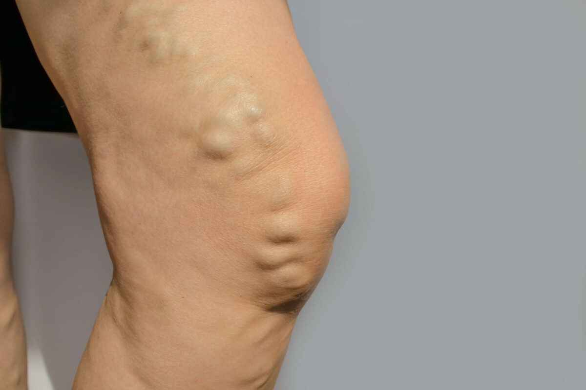Why are My Varicose Veins Bulging More? - Heart of Dixie Vein Center