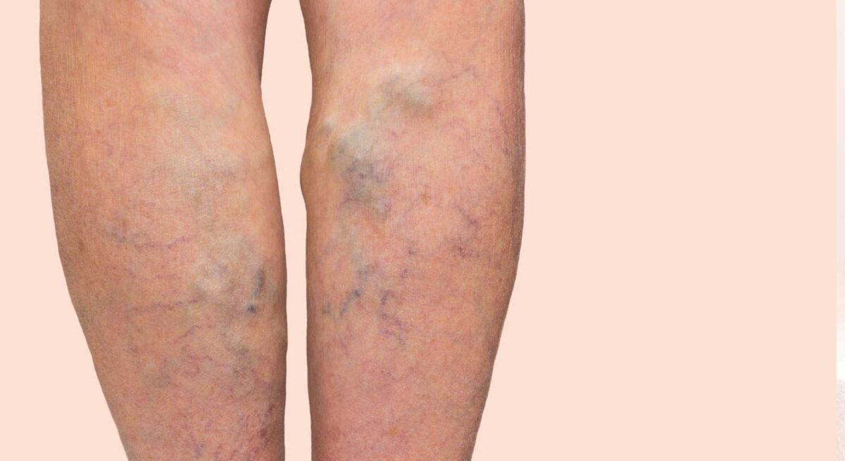 4 Benefits of VenaSeal | Varicose Vein Treatment Center | Utah